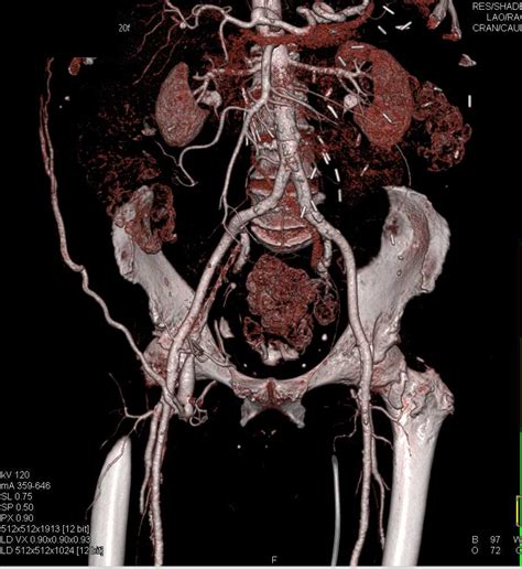 Iliofemoral Bypass Technique Bypass From Iliac Artery To