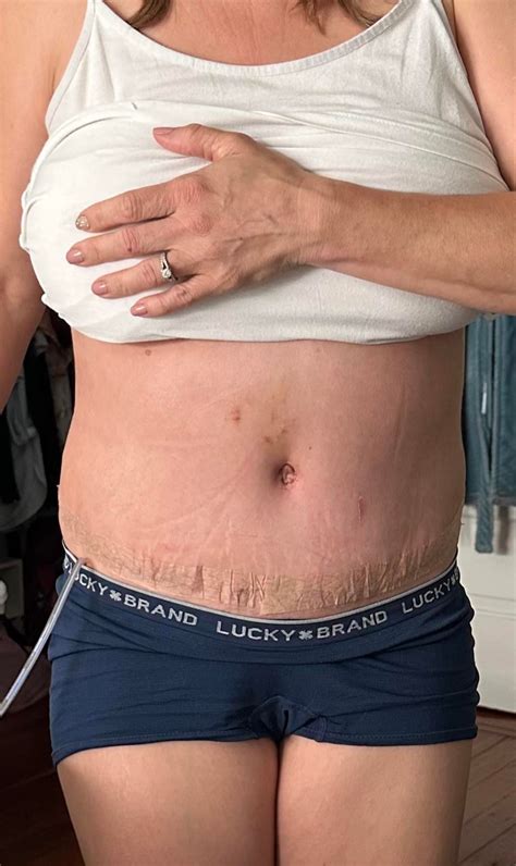 Before Day Of 1 Week And 25 Weeks Post Op Tummy Tuck With Lipo R