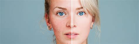Skincentral Dermatology Aesthetics And Lasers