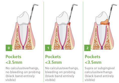 Classification Of Periodontal Disease Health And Plaque Induced
