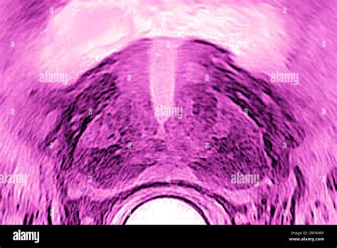 Prostate Healthy Prostate Gland Visualized In Ultrasound In Frontal