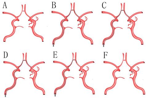 Endovascular Treatment For Aneurysms Located In The Posterior
