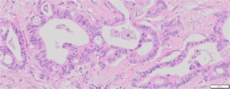 Human Pancreas Cancer Adenocarcinoma Ffpe Sections Human Pancreas Cancer Adenocarcinoma Ffpe Sections