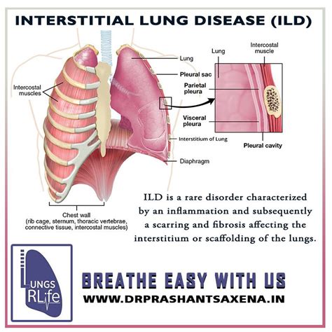 Interstitial Lung Disease Ild Artofit