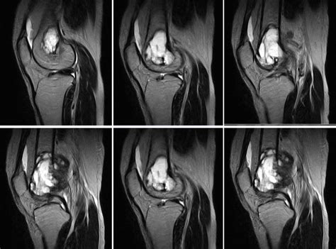 骨巨细胞瘤图片 骨巨细胞线图片 骨巨细胞线表现 大山谷图库