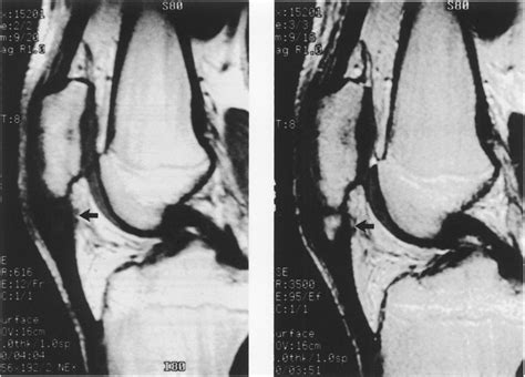 Mri Of Patellar Tendonitis A And B Ti Weighted Tr616 Msec Te 12 Download Scientific Diagram