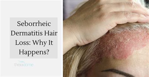 Seborrheic Dermatitis Hair Loss Why It Happens And How To Treat Theradome