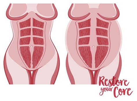 Diastasis Recti During Pregnancy Restore Your Core