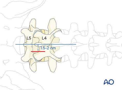 Interlaminar Microscopic Tubular Lumbar Discectomy Imtld For Lumbar