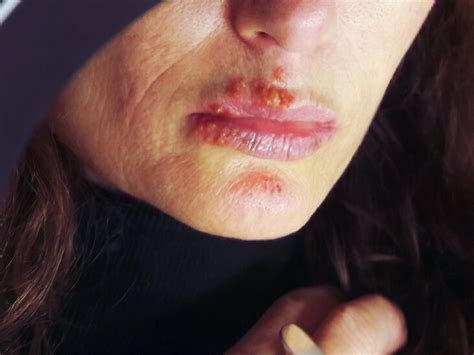 Fever Blisters On Face