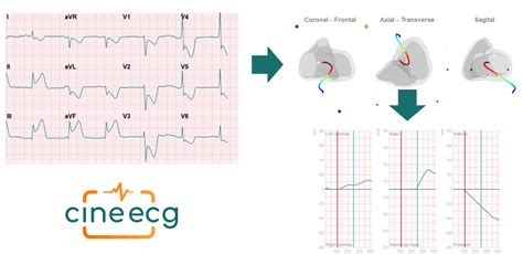 Inferior Wall Infarction Ecg Excellence