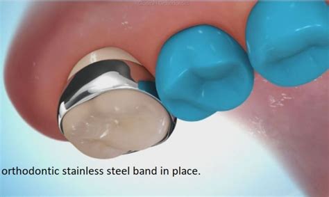Types Of Orthodontic Separators At Christopher Elias Blog