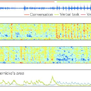 The Micro ECoG Grid And Surgical Placement A A Single Electrode Download Scientific