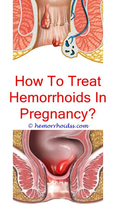 Should I Pop A Hemorrhoid Cure For Hemorrhoids Hemorrhoid Remedies Bleeding Hemorrhoids