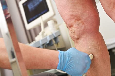 What Is Venous Insufficiency And How Is It Linked To Obesity