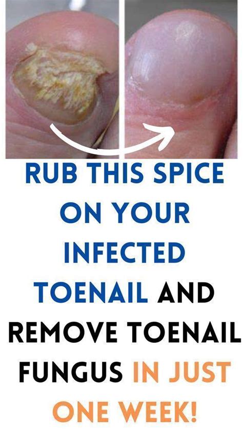 Rub This Spice On Your Infected Toenail And Remove Toenail Fungus In