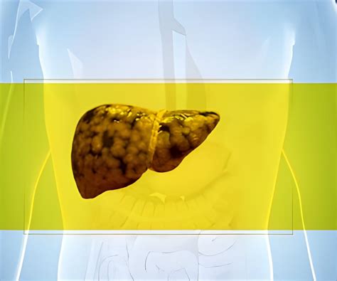 Indians Predisposed To Insulin Resistance More Prone To Fatty Liver Disease