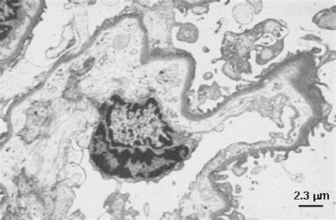 Electron Micrograph Of A Glomerular Capillary From A Patient With Hus Download Scientific