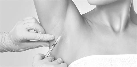Hyperhidrosis Isle Of Man Excessive Sweating Treatment Botox