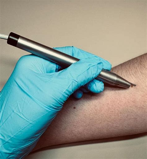 Benign Skin Leisons Maeskn Aesthetics Guildford