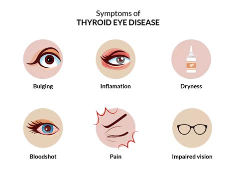 Thyroid Eye Disease Symptoms Causes And Treatment 53 Off