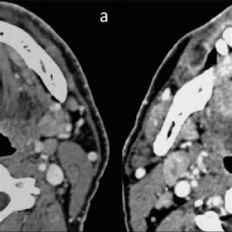 Peculiar Findings Of Pathological Lymph Nodes On Ultrasound