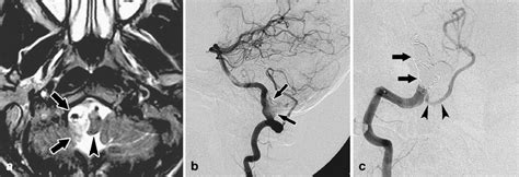 Dissection Of The V4 Segment Of The Vertebral Artery Clinicoradiologic