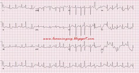 Ecg Rhythms Multifocal Atrial Tachycardia Mat Chaotic Atrial