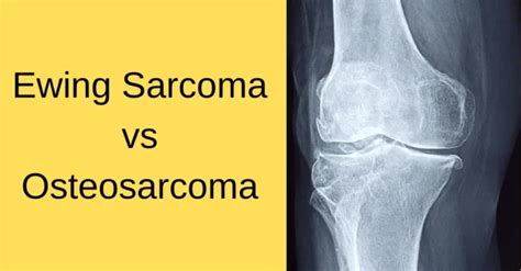 Ewing Sarcoma Vs Osteosarcoma Key Differences Explained