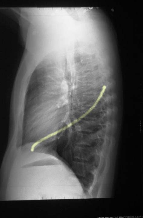 Chest X Ray Lung Parts And Fissures Cxr Lungs