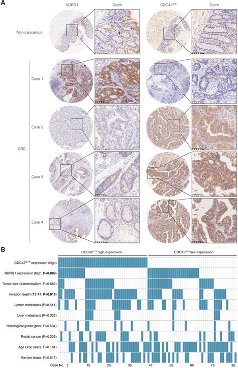 Cdc42 Gtp Is Frequently Upregulated In Crc Tissues And Correlated With