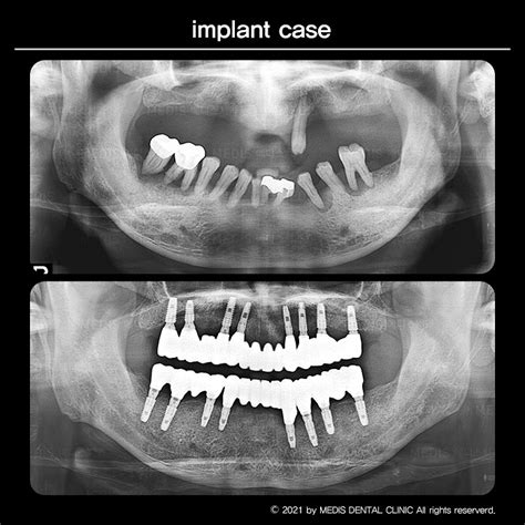 타치과에서 임플란트 실패 경험이 있으셔서 많이 걱정하셨던 서면 메디스치과 Since 2008