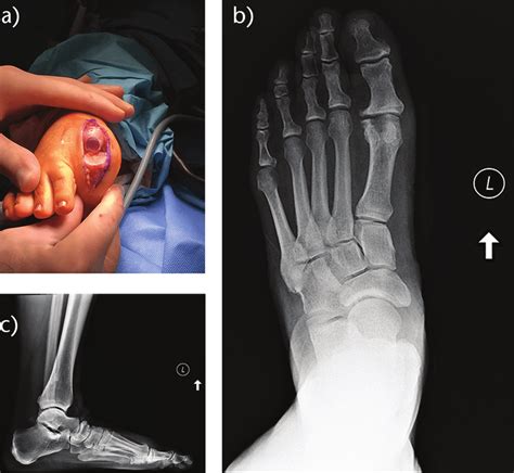 Synthetic Cartilage Replacement A Intra Operative Example Of A
