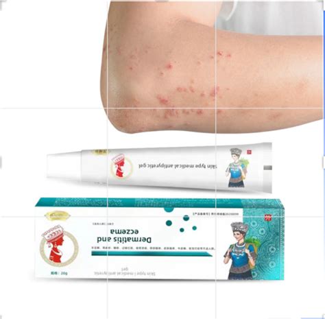 Eczema And Dermatitis Ointment 20g Memazon