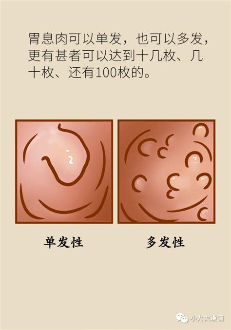 胃息肉癌变风险有多大？看这2个指标澎湃号·湃客澎湃新闻 The Paper