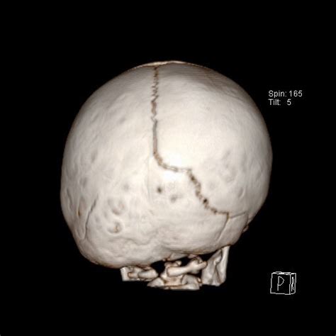 Unilateral Lambdoid Craniosynostosis Is The Rarest And Results In Download Scientific Diagram