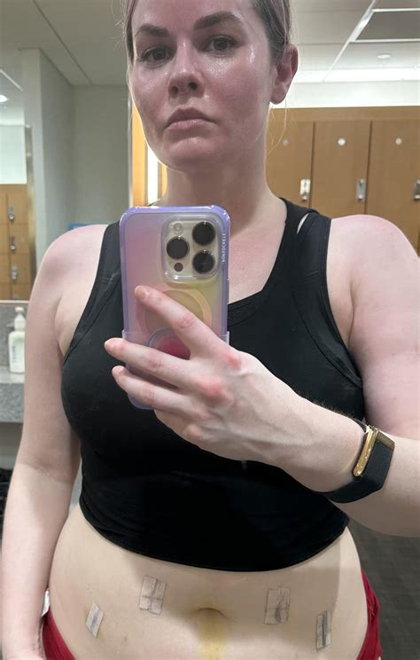 Just Had My 2 Week Follow Up Robotic Myomectomy Update R Fibroids