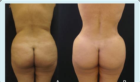 Shows A 3 Month Follow Up A Before B After The Surgery Download Scientific Diagram