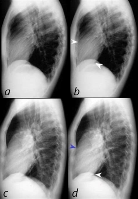 Lateral View Chest Xray Basic Cxr Heart