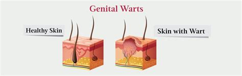 Preventing Genital Warts Tips And Strategies Ask The Nurse Expert
