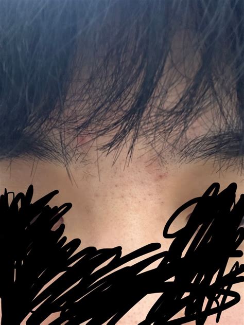 미간 여드름 지식in