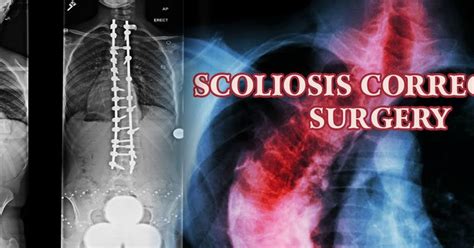 Get The Best Scoliosis Correction Surgery In Gurgaon Treatment At
