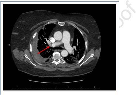 Chest Cta Showed Bilateral Segmental Pulmonary Emboli Distal Right Download Scientific Diagram