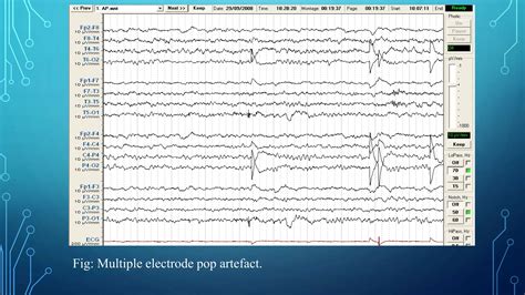 Eeg Lecture 3 Artifacts And Benign Eeg Variants Pptx