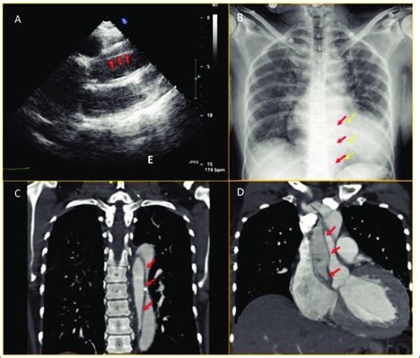A Transthoracic Echocardiogram In Parasternal Long Axis View Showing Download Scientific