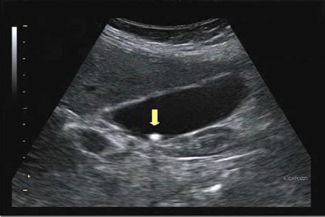 Evaluación doppler ultrasonografica de los cambios hemodinámicos en las