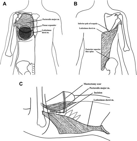 A To C Schematic Drawing Of The Latissimus Dorsi Ld Teres Major Tm