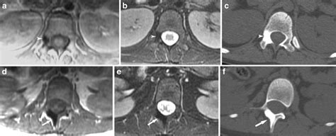 A 12 Year Old Girl With Tuberous Sclerosis Complex And Tsc2 Mutation