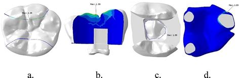 Stress Distribution Of An Endodontically Treated Tooth Ccide