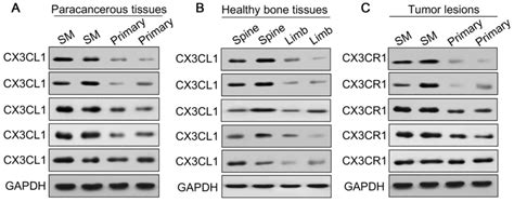 Cx3cl1fractalkine Enhances Prostate Cancer Spinal Metastasis By